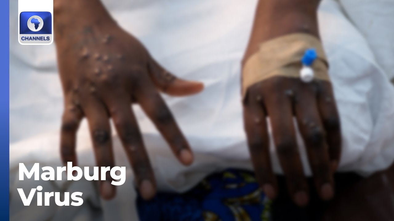 Tanzania Confirms Marburg Virus Case After Initial Denial + More ...