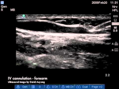 US Guided PIV with Longitudinal & Transverse View - YouTube