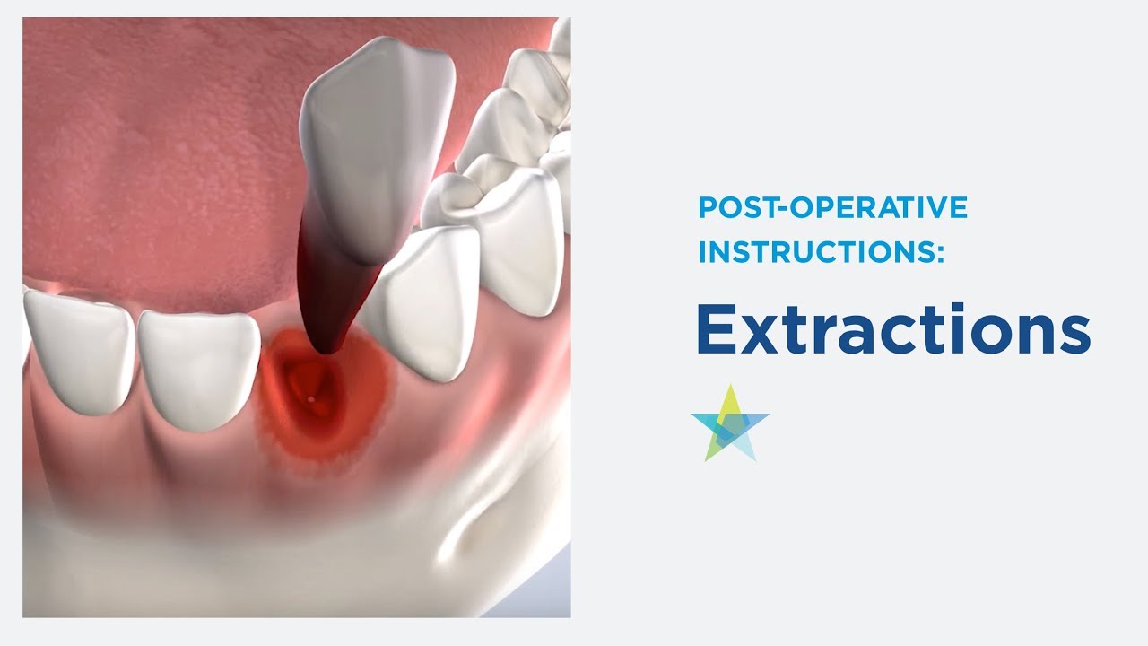 Post-Operative Instructions: Extractions | Park Cities Oral ...