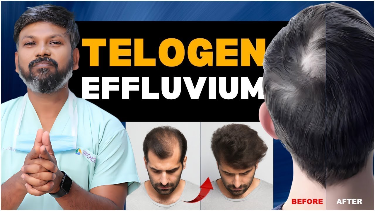 #AskDrJohnWatts | TELOGEN EFFLUVIUM | Hair Specialist Explains - YouTube