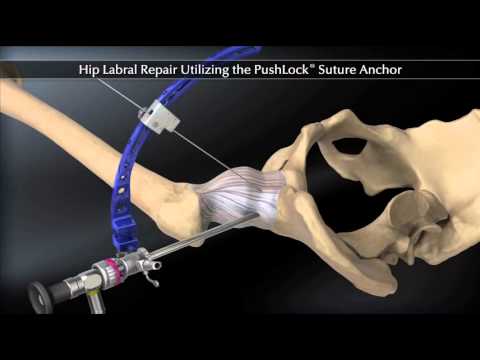 Hip Labral Repair Utilizing the PushLock - Suture Anchor (C) - YouTube