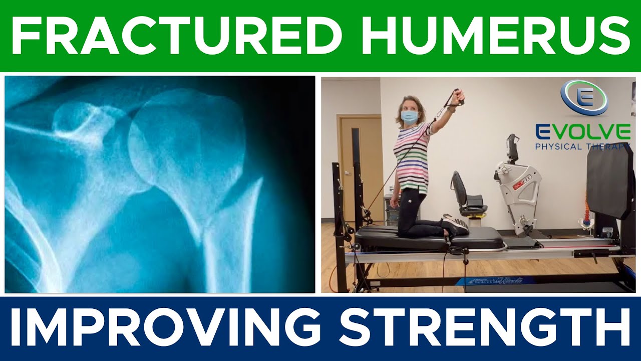 Fractured Humerus | Improving Strength | Part 4 - YouTube