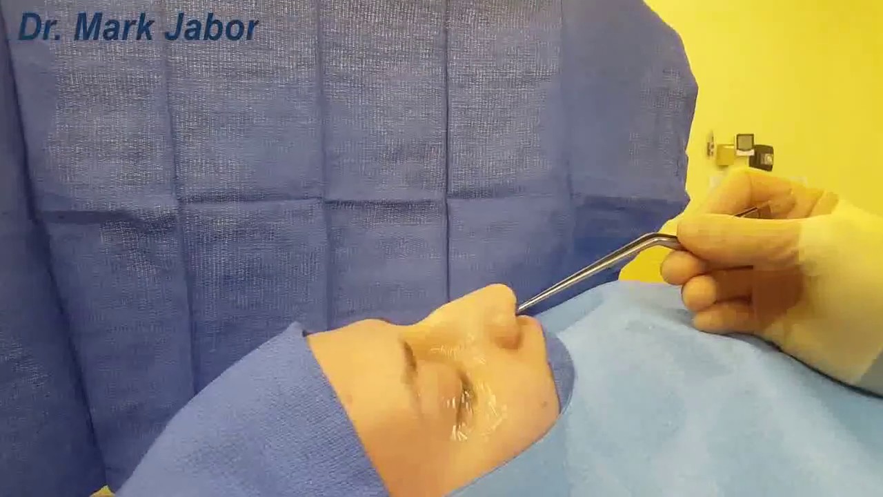 Dr. Mark Jabor - Rhinoplasty (nose job) in El Paso, TX - YouTube