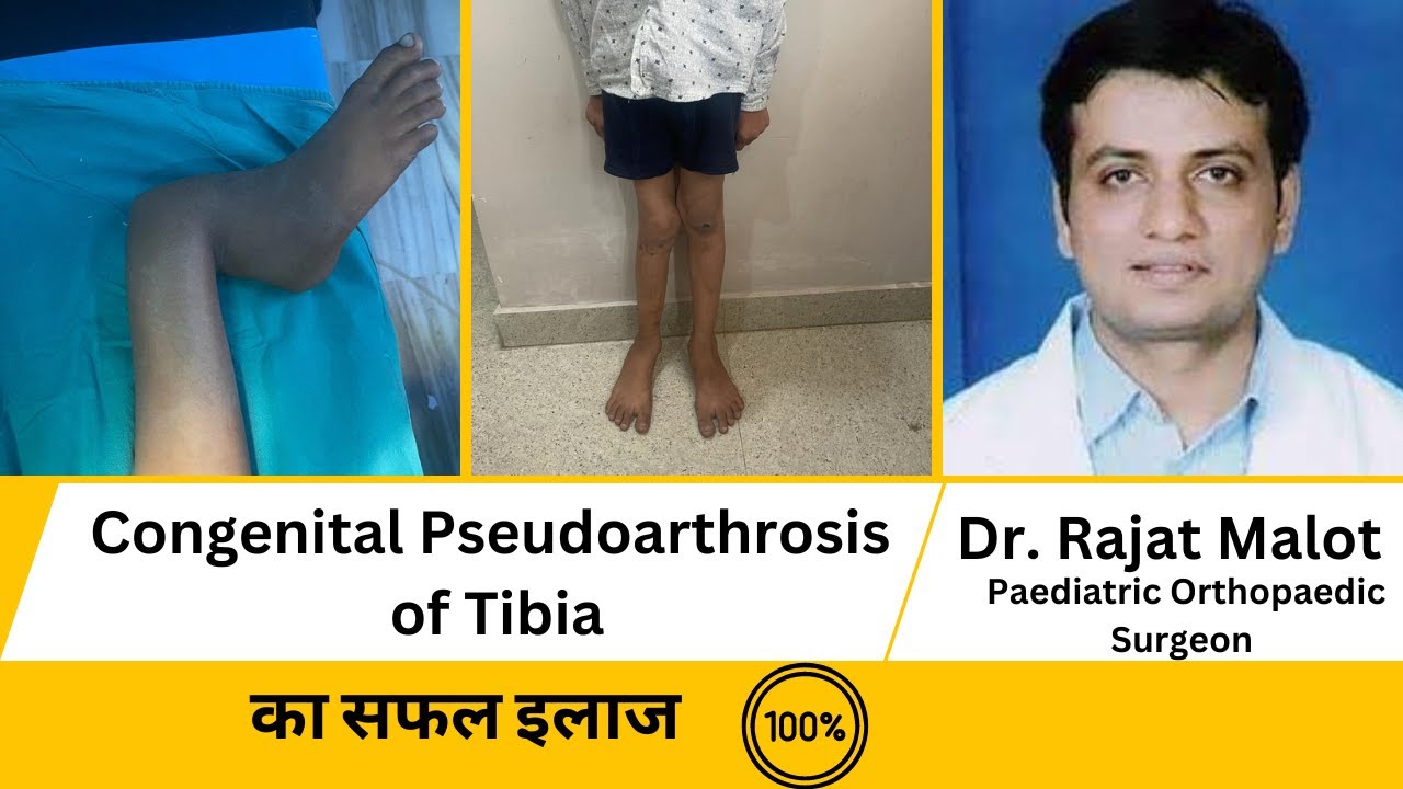 Congenital Pseudoarthrosis of Tibia (CPT) का सफल इलाज | - YouTube