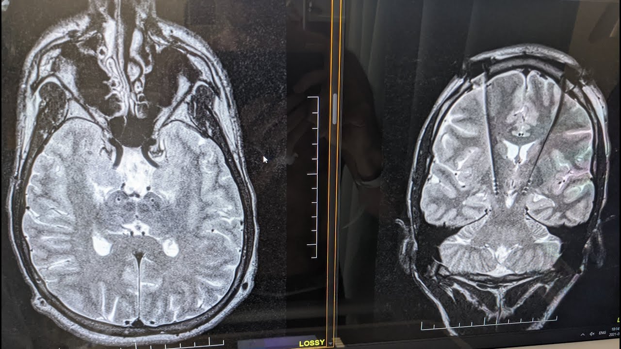 showcasing the latest in adaptive deep brain stimulation technology ...