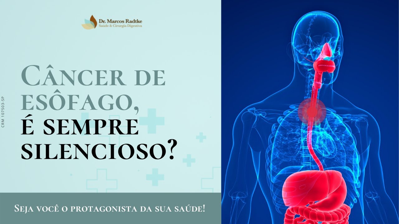 Você conhece os sintomas do câncer de esôfago? | Dr. Marcos Radtke ...