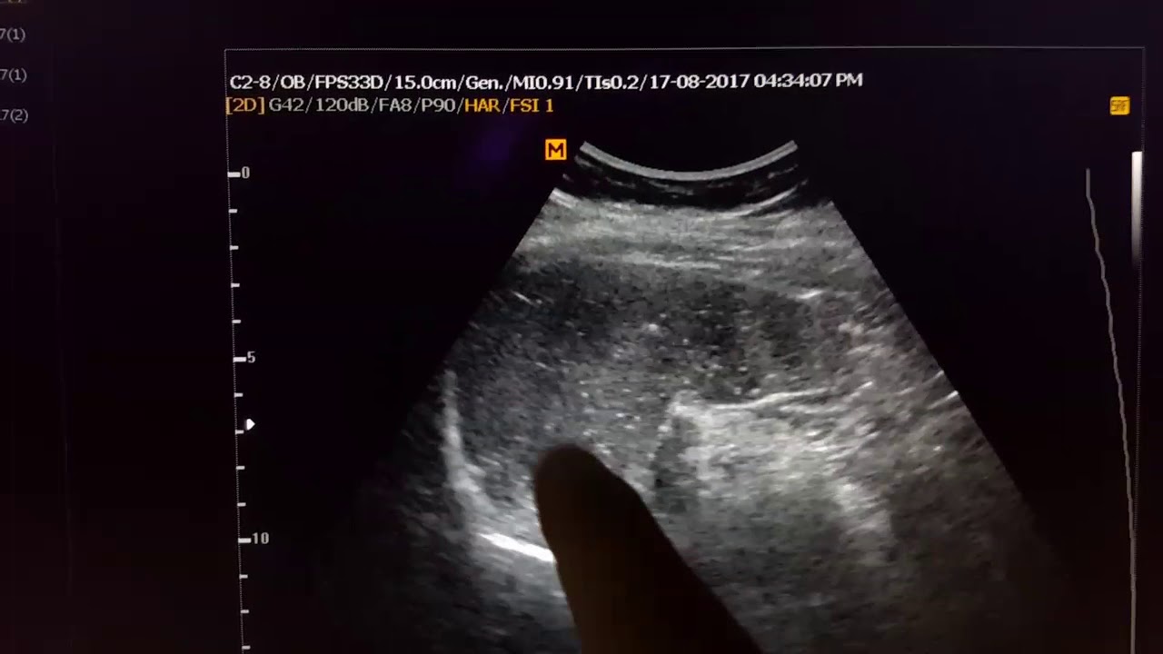 Spleen With Tiny Echogenic Foci YouTube