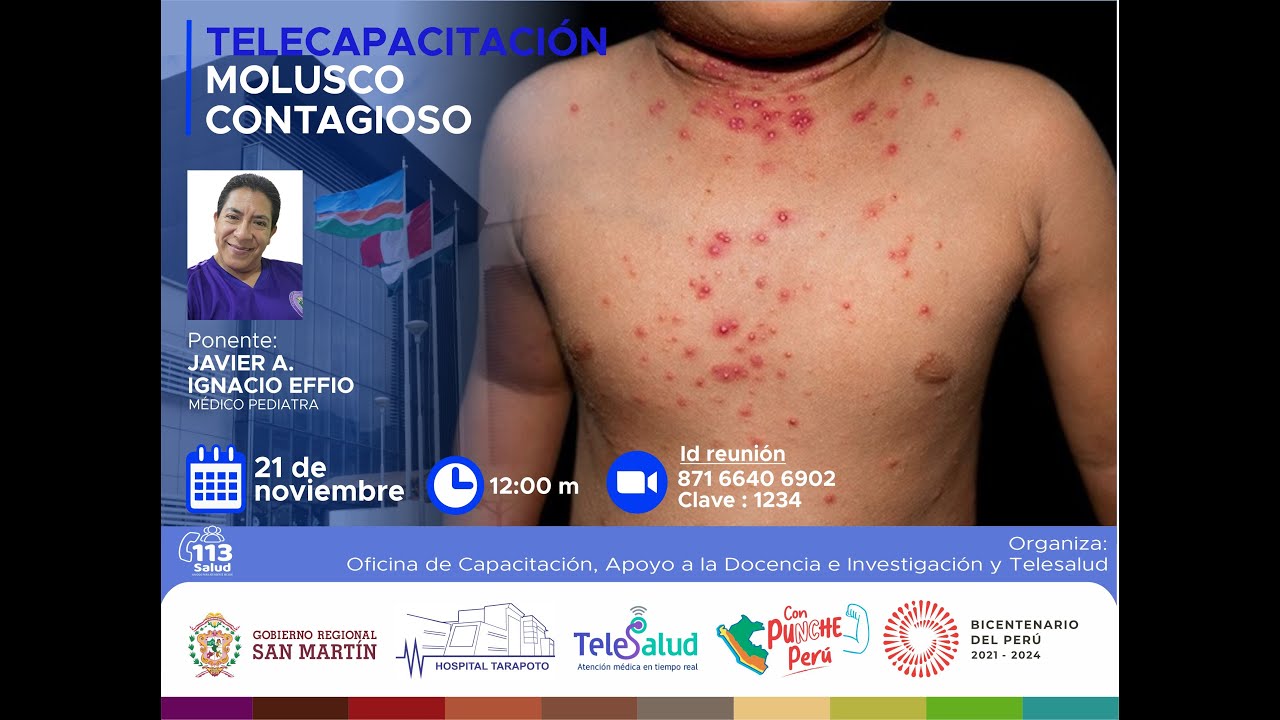 MOLUSCO CONTAGIOSO - YouTube