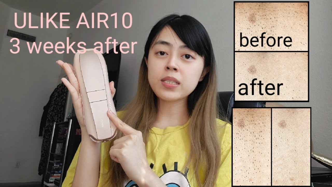 Ulike air10 IPL hair removal after 3 weeks (quick update) - YouTube