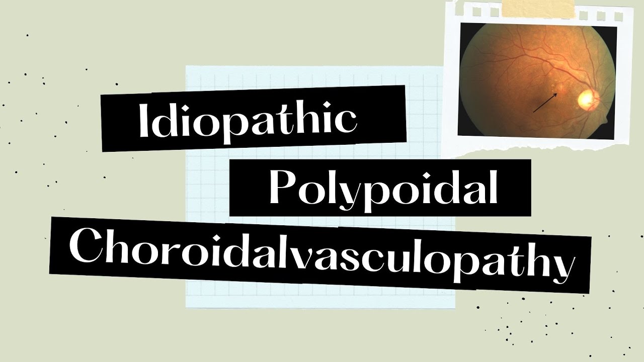 Idiopathic Polypoidal Choroidal Vasculopathy - YouTube
