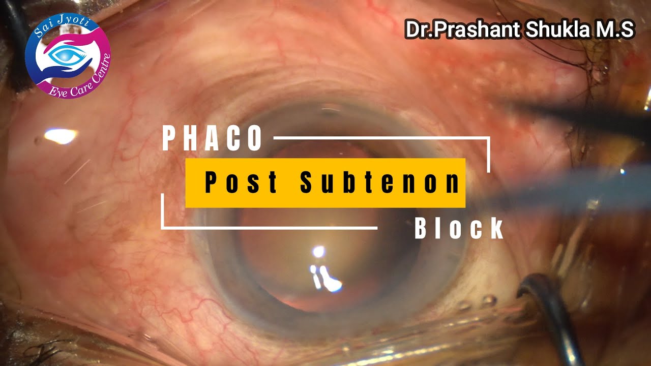 Phacoemusification With Posterior Subtenon Block - YouTube
