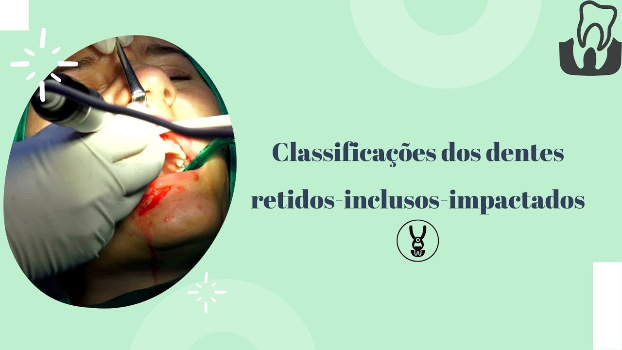 Classificação dos Dentes Inclusos / Impactados - YouTube