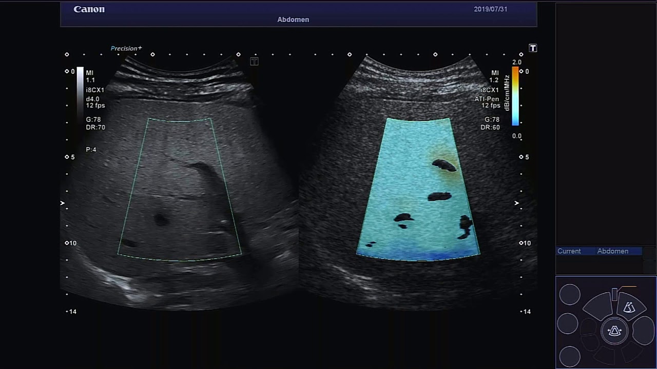 ATI Liver Steatosis - Canon Medical Systems - YouTube