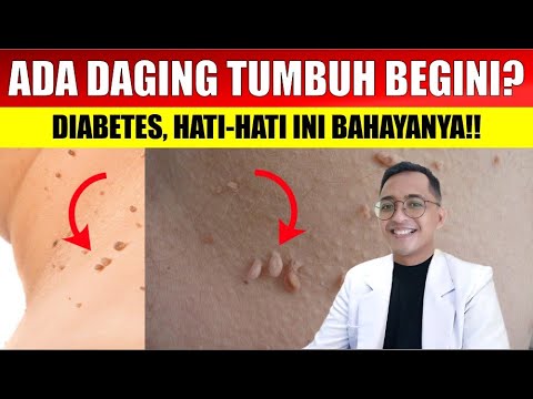 JANGAN ABAIKAN! Ini Arti Kutil di Leher, Punggung, Ketiak, atau Sekitar ...