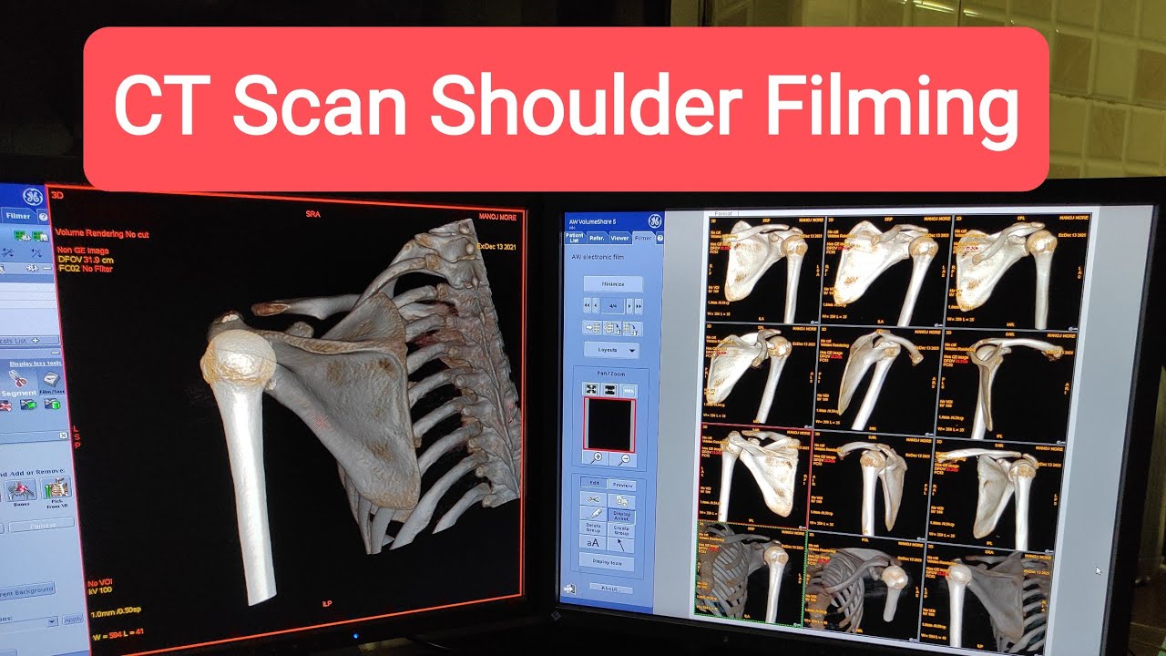 Shoulder CT scan Filming Protocol. - YouTube
