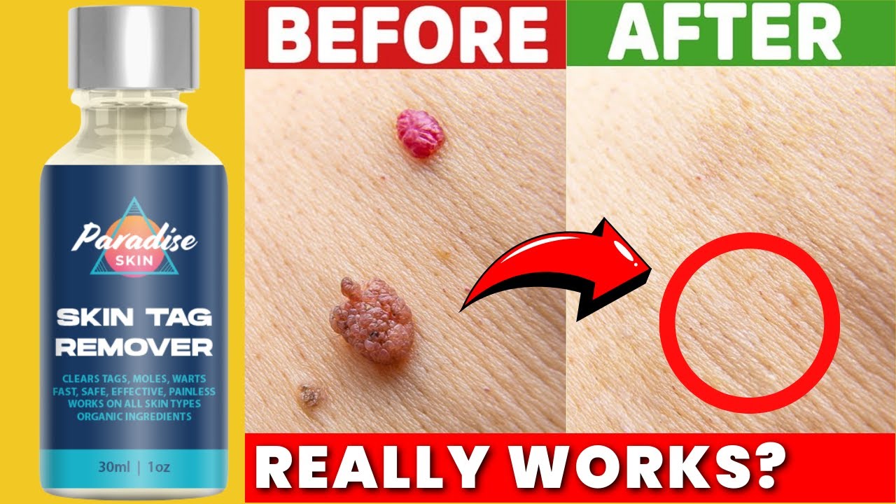 Paradise Skin Tag & Mole Remover: Does It Really Work? Watch This ...