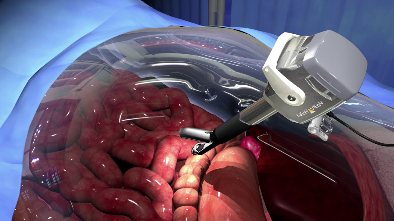 New View Surgical VisionPort Full Sequence July 2019 - YouTube