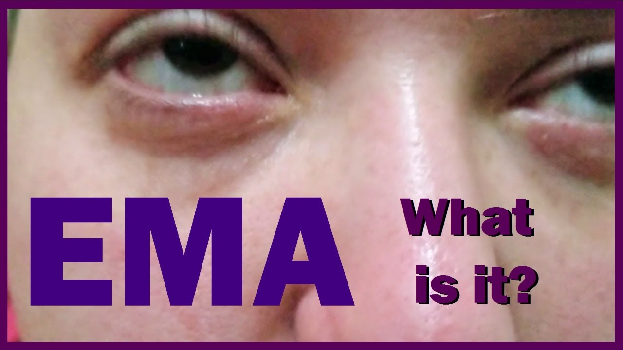 EMA Eyelid Myoclonia with Absences Jeavons syndrome _Status epilepticus ...
