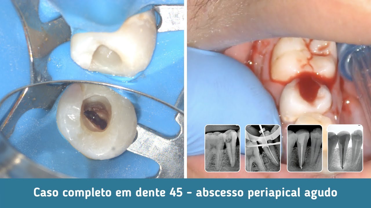 Caso clínico completo - abscesso periapical agudo em dente 45 - YouTube