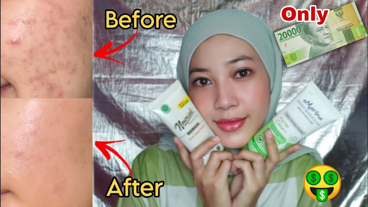 Perawatan Wajah Berjerawat Youtube