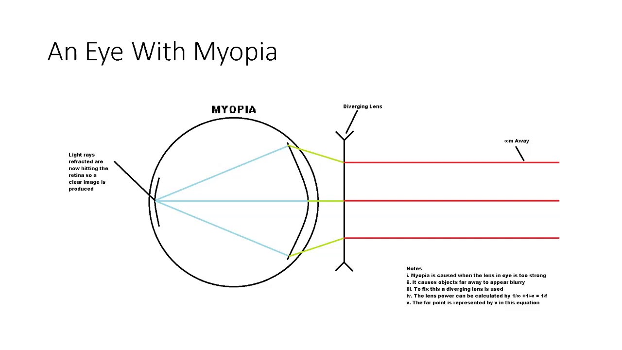 A-Level Physics, Vision Defects - YouTube