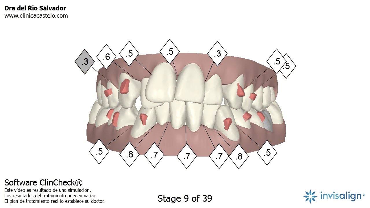 Clincheck Invisalign - Vídeo en 3D - YouTube