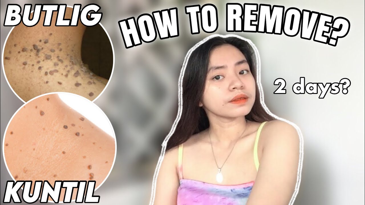 BUTLIG at KUNTIL REMOVER ( SUPER EFFECTIVE) | Philippines - YouTube