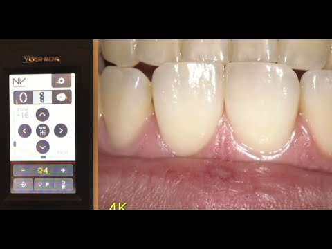 Mielscope Auto-zoom Capability - YouTube