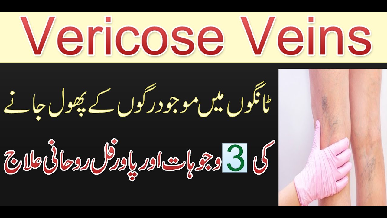 Vericose Veins Yani Tango Ki Ragen Phool Jane Ki 3 Wajohat Aur Powerful ...