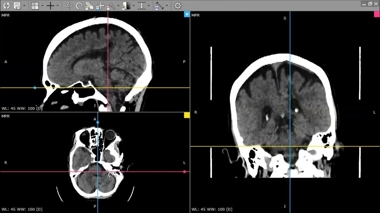 Basic CT Scan Interpretation - YouTube