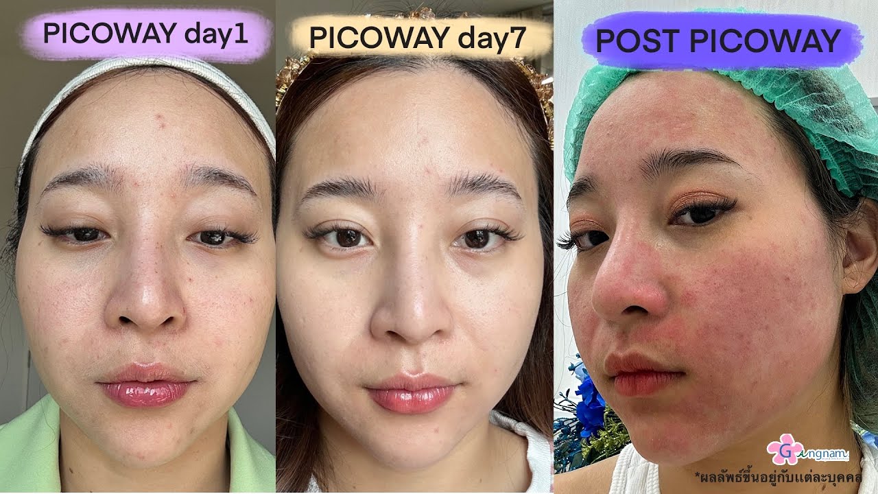 Picoway เลเซอร์หลุมสิว กระชับรูขุมขน เห็นผลลัพธ์เร็ว ไม่ทิ้งรอยเเผลเป็น ...
