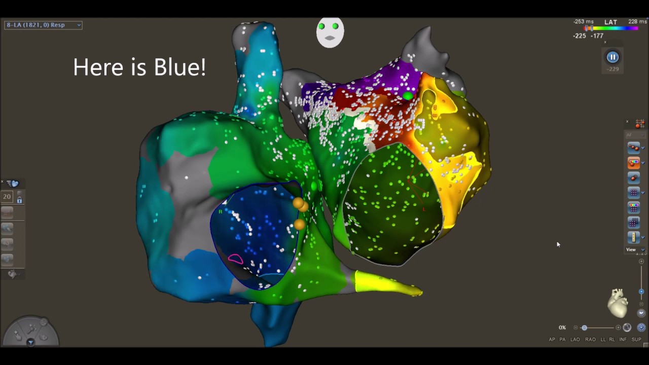 Figure 8 Biatrial Flutter connecting via Bachmann's Bundle - YouTube