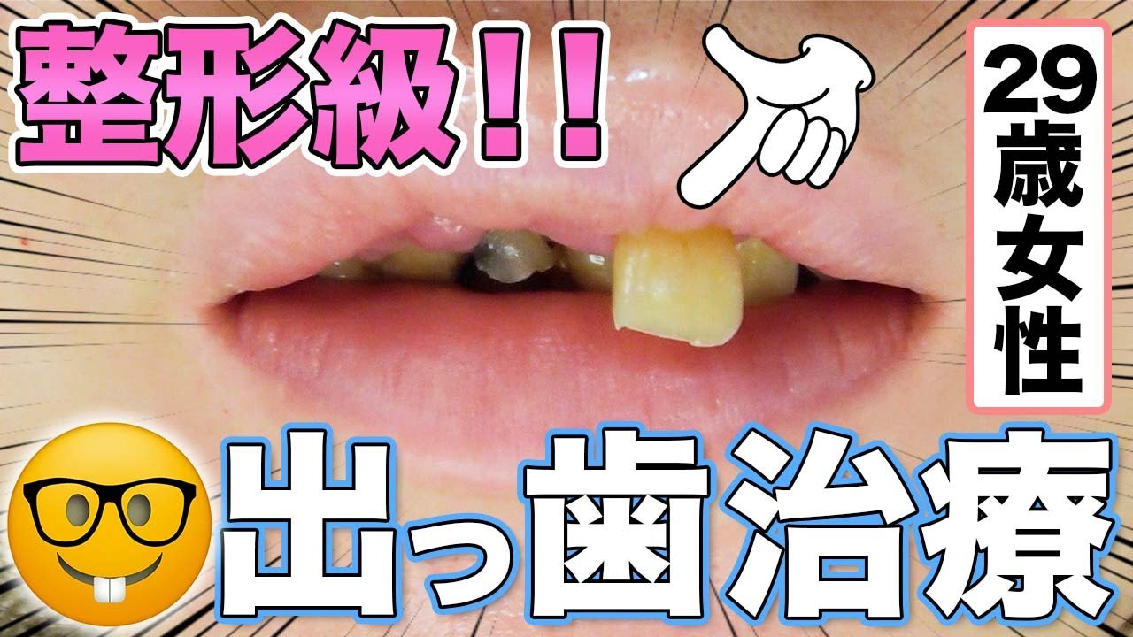 【29歳女性】整形級出っ歯治療🦷 [29 year old female] Plastic surgery-grade bucktooth ...