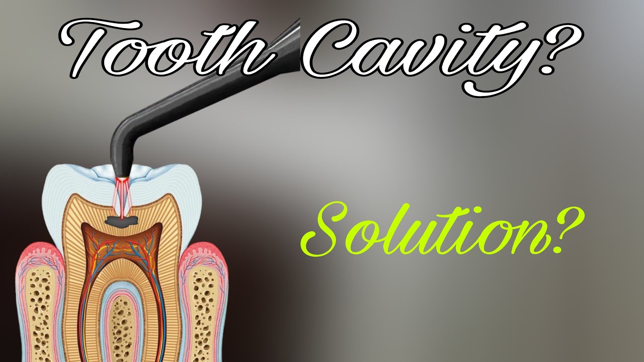 What is tooth cavity? Solution of tooth cavity | দাঁতে পোকা কিভাবে লাগে ...