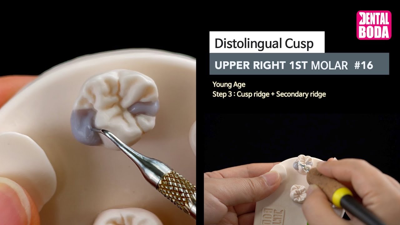 Upper Right 1st Molar distolingual cusp 3 ridge (young-aged) Wax-Up #16 ...