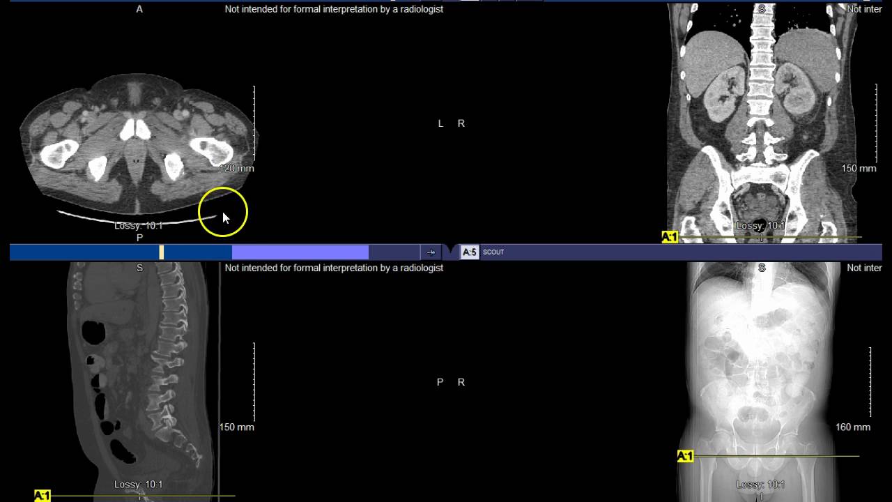 PACS - CT Male Pelvis - YouTube