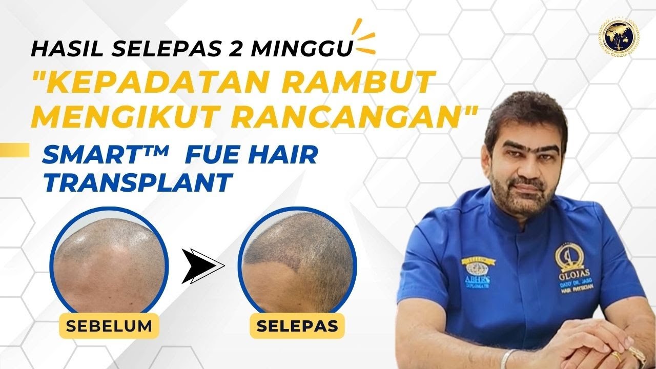 Tanam Rambut SMART™ FUE: Hasil Kepadatan Rambut Selepas 2 Minggu ...