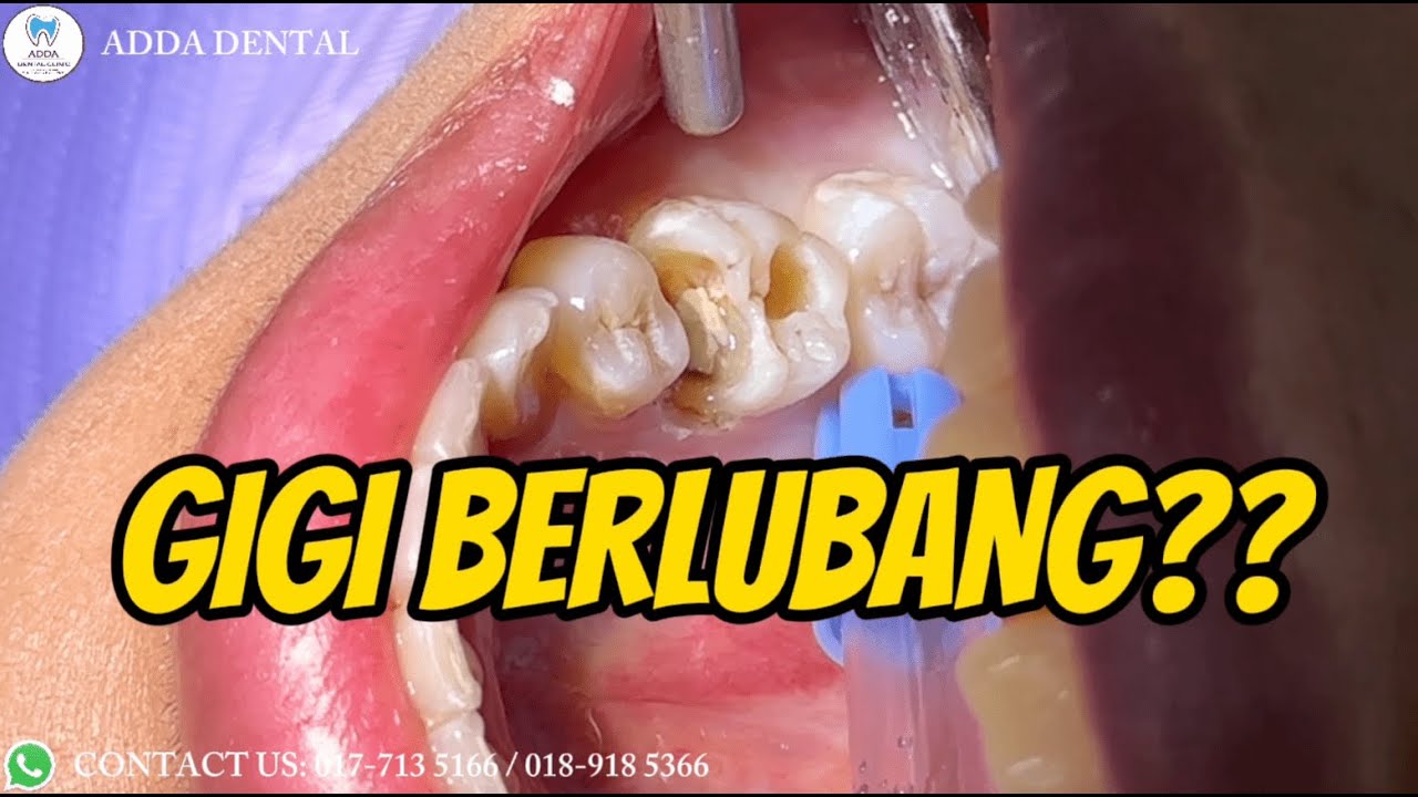 Gigi Berlubang | Tampalan Gigi | Fillings | Dentist | Adda Dental ...