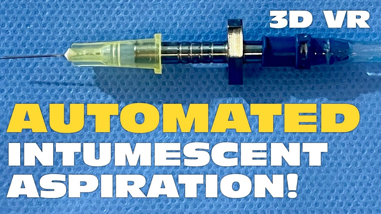 3D Phaco Clip #116 - Apostolov's Automated Needle Cortex Aspiration ...