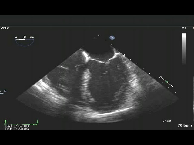 Transesophageal Echocardiogram 4 Chamber A Systematic Approach To