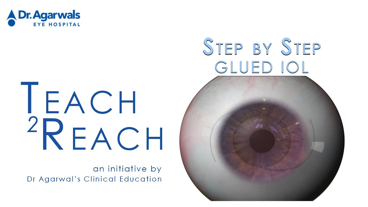 Step by Step for Glued IOL - YouTube