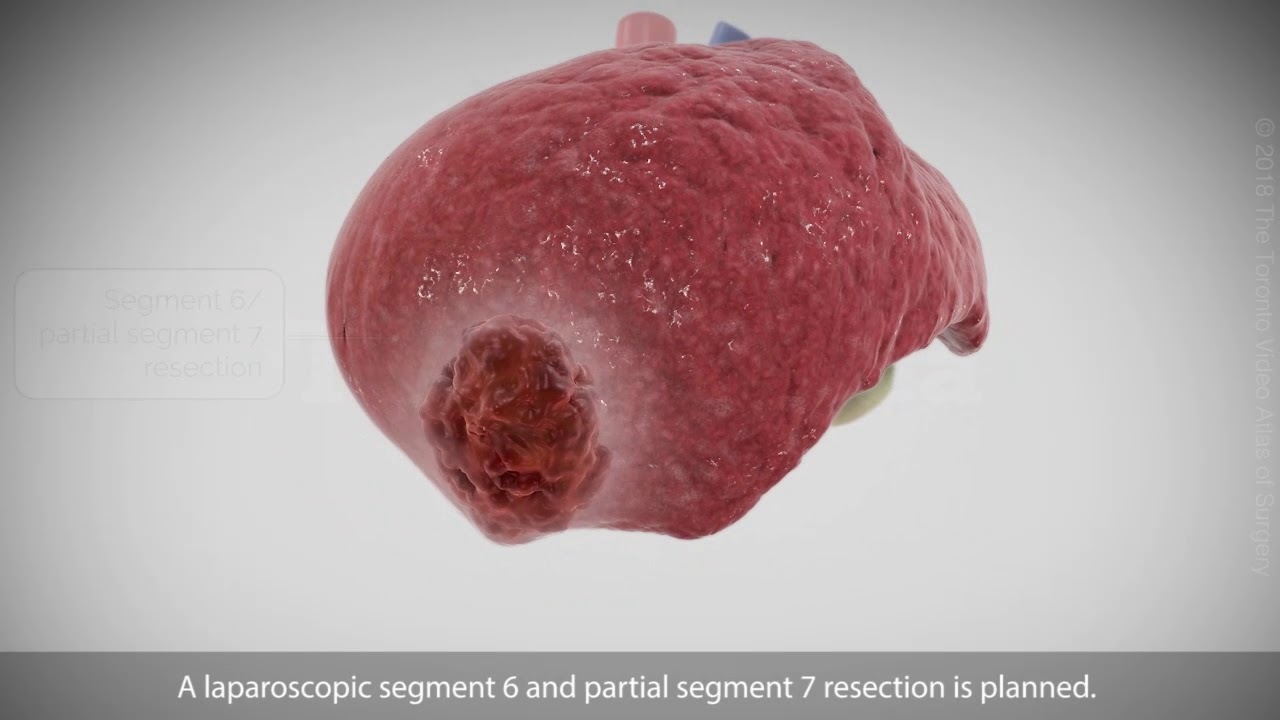 Laparoscopic right posterior sectionectomy - YouTube