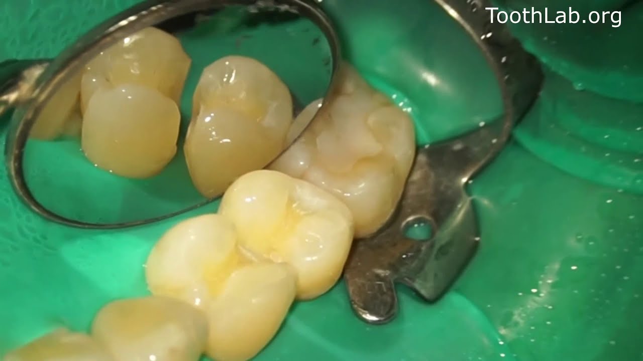Gold Inlay Preparation-Maxillary Premolars - YouTube