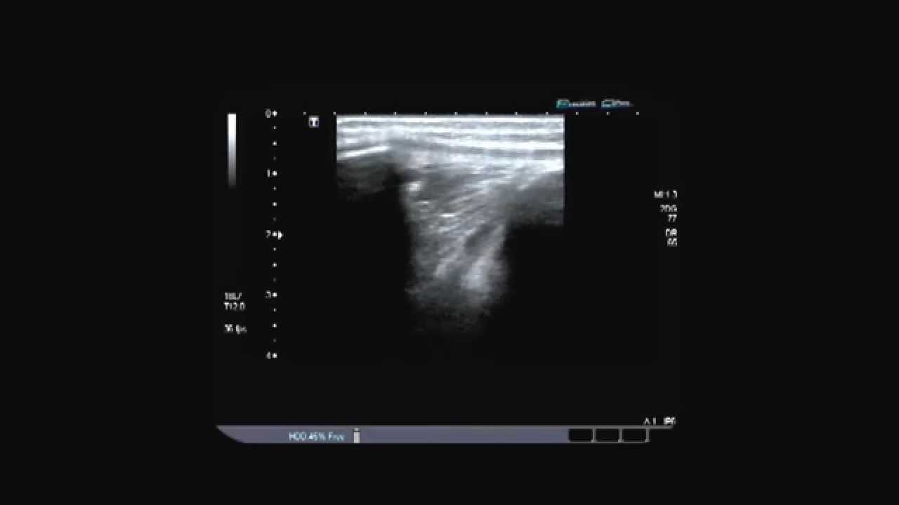 ACL Ultrasound dynamic examination - YouTube