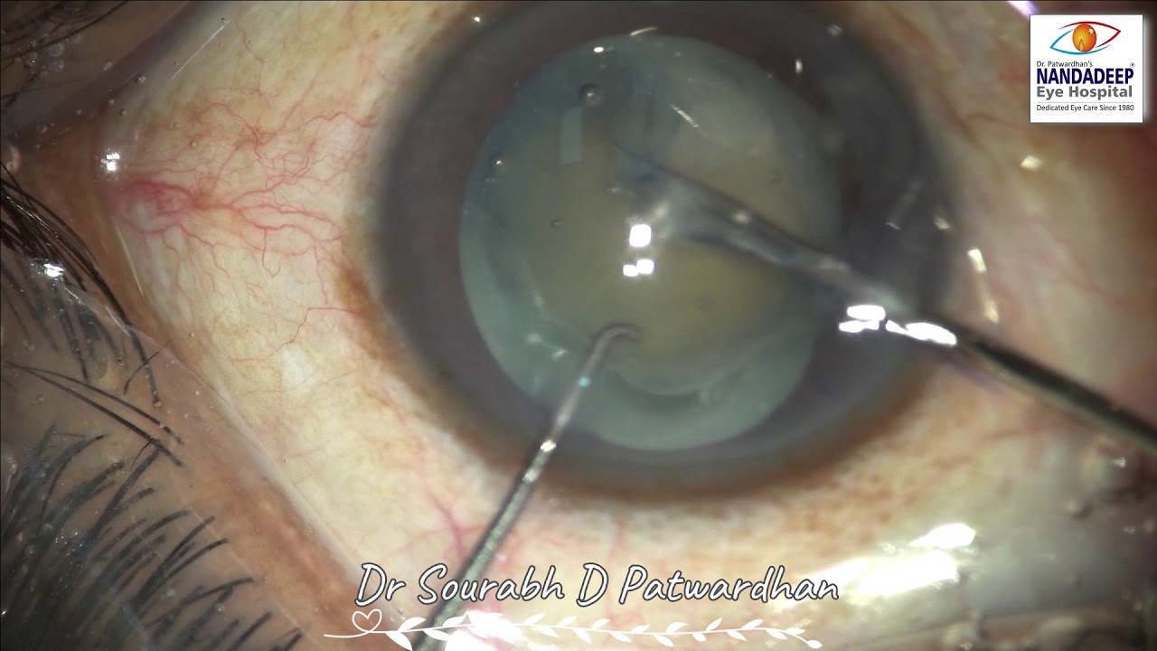 Morgagnian cataract: tips Dr Sourabh Patwardhan - YouTube