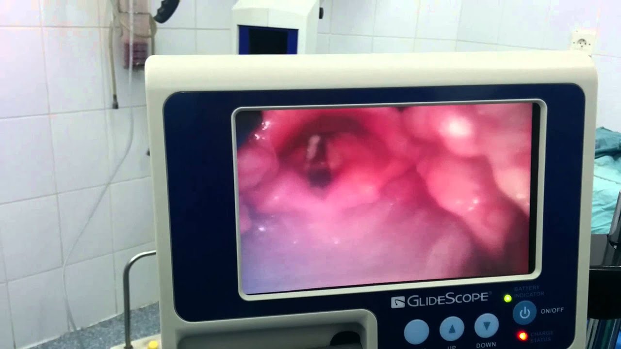 Intubation using the Glidescope Video Laryngoscope - YouTube