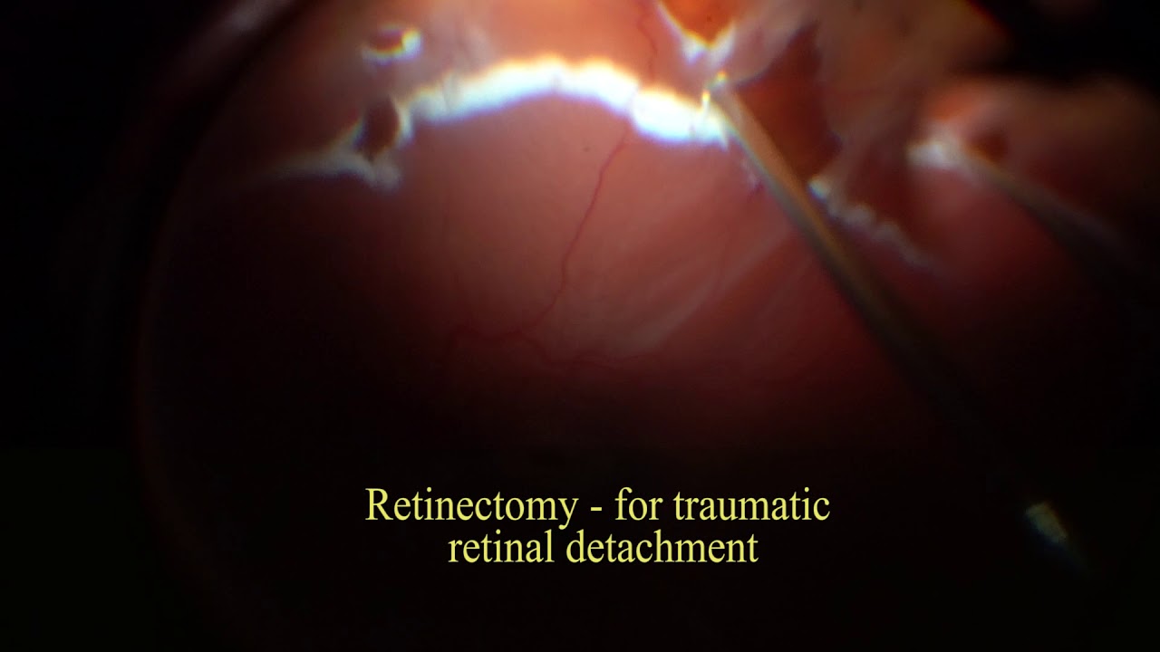 Retinectomy for traumatic retinal detachment with PVR - YouTube