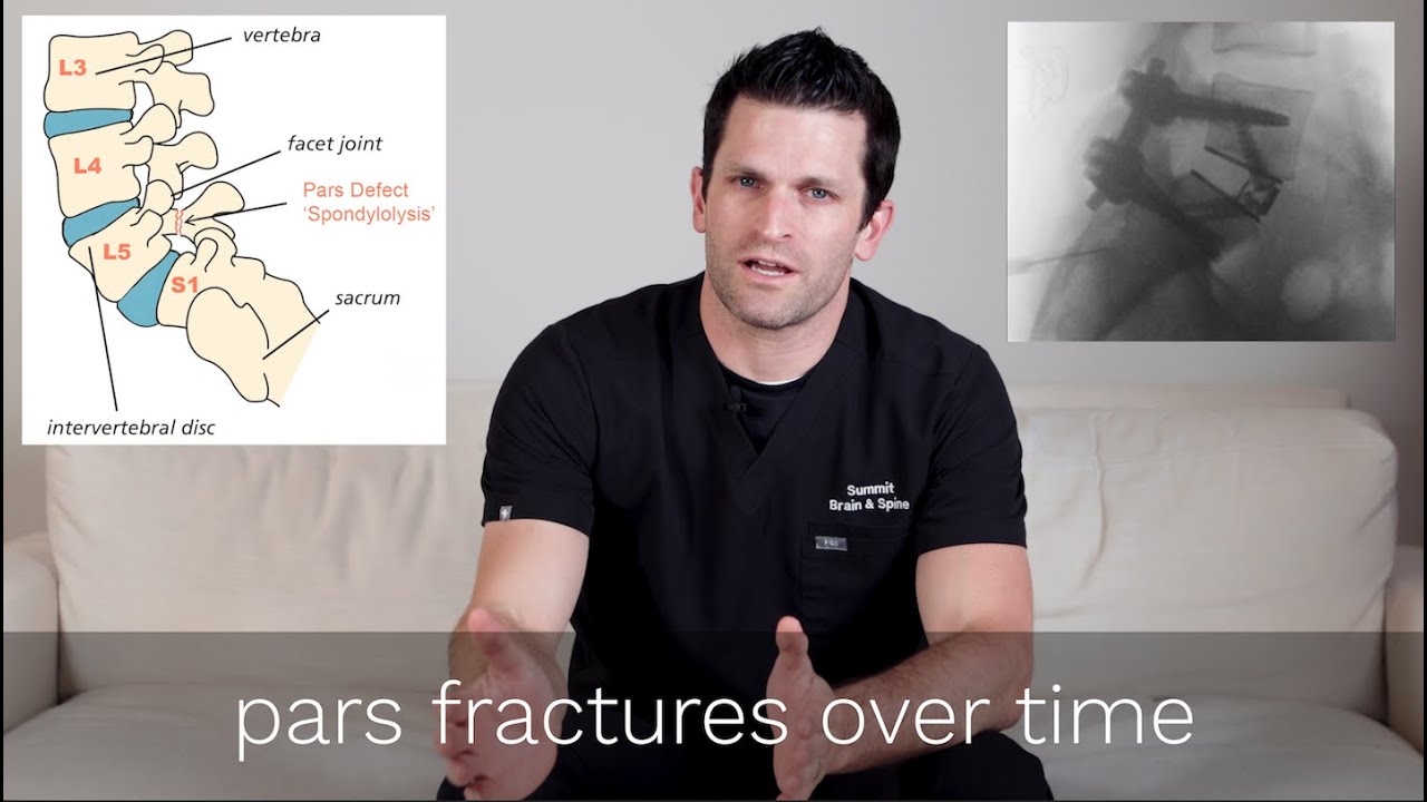Pars Fractures Over Time - YouTube