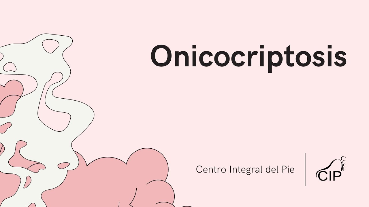 ONICOCRIPTOSIS | Centro Integral del Pie - YouTube