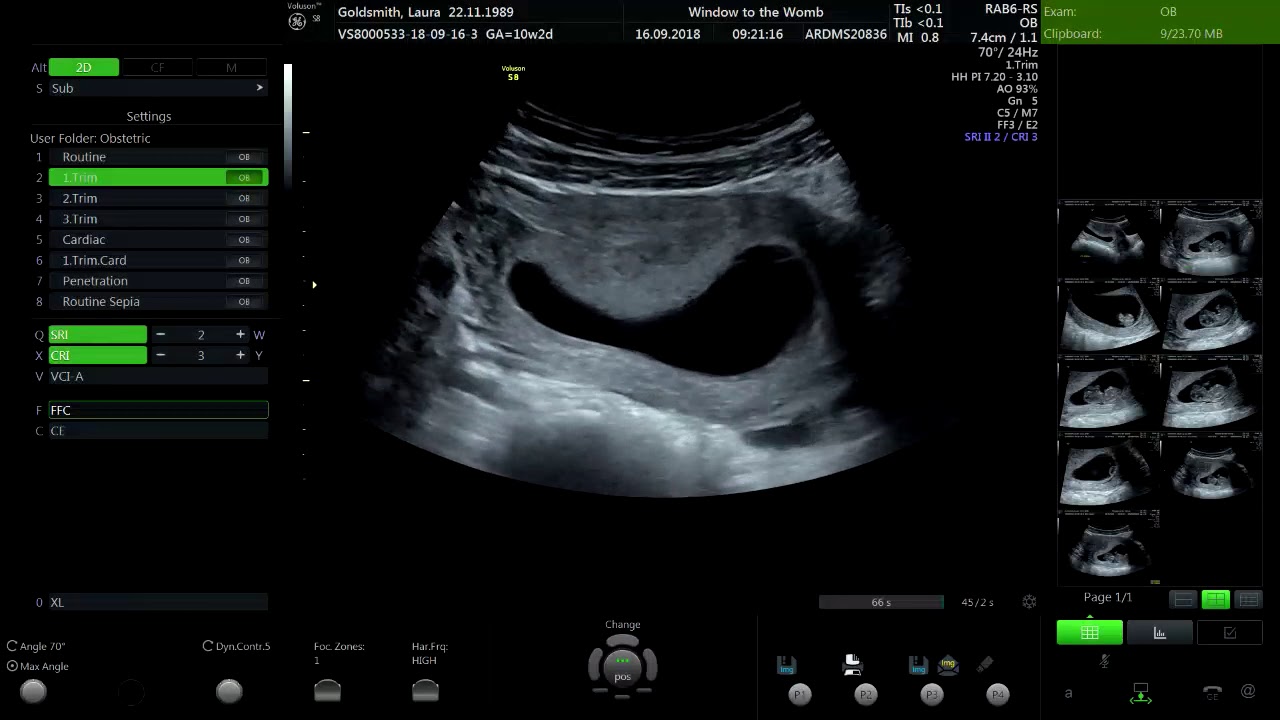 10 Weeks Baby Scan Ultrasound - YouTube